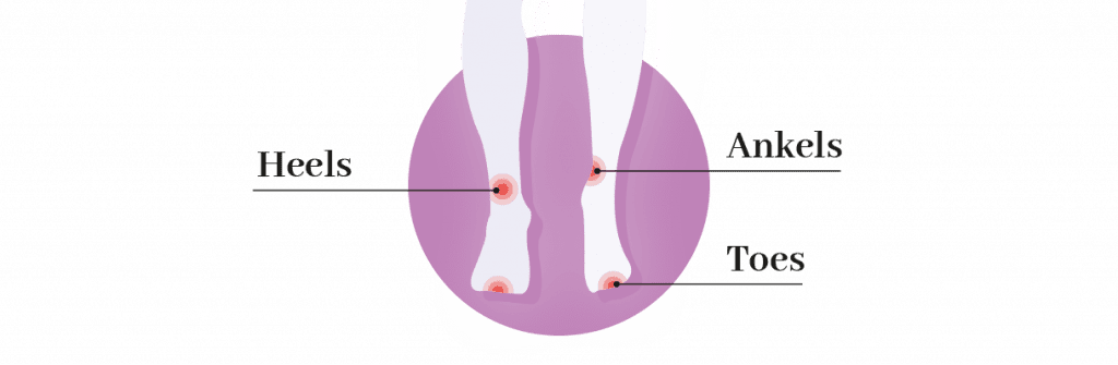 Blisters on Feet - antichafing.net